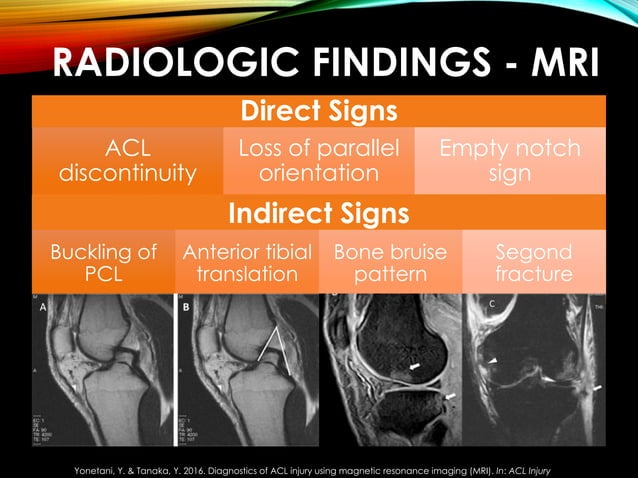 ACL Injury diagnosis and management.pptx