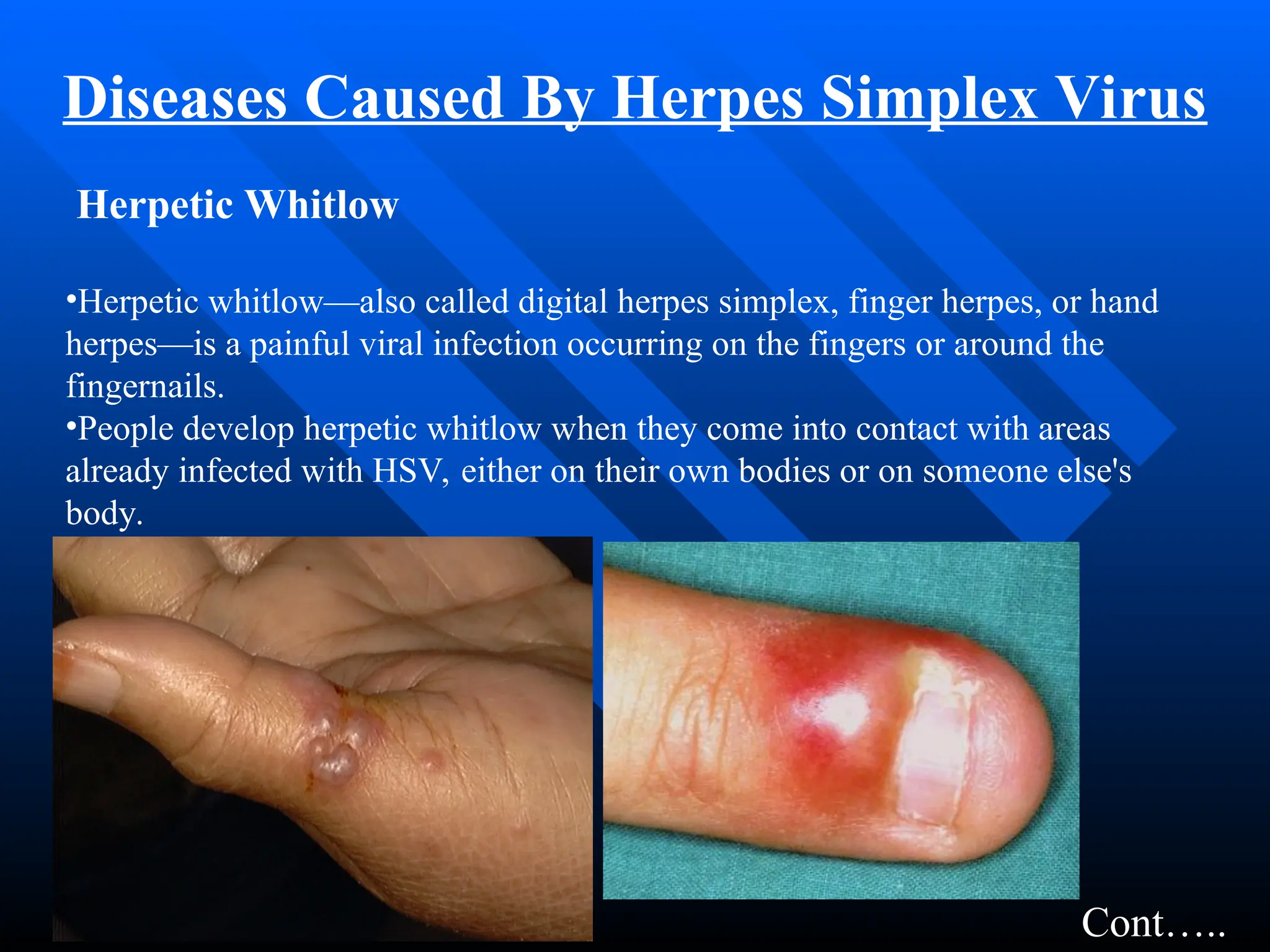 Aclova is an antiviral medication primarily used to treat infections ...