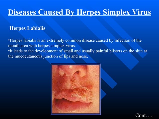 Aclova is an antiviral medication primarily used to treat infections ...