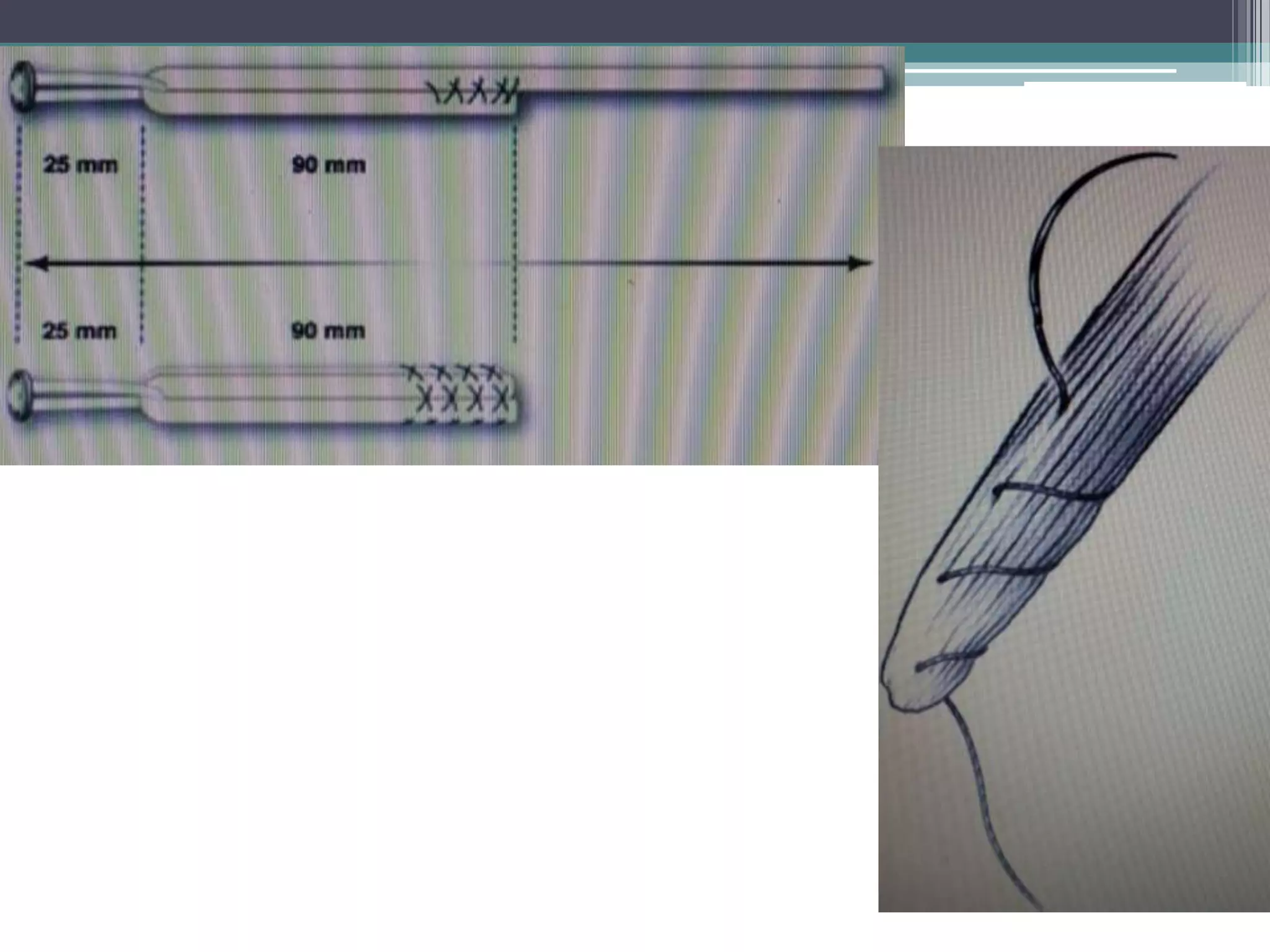 ACL reconstruction quadrapled hamstring graft | PPTX