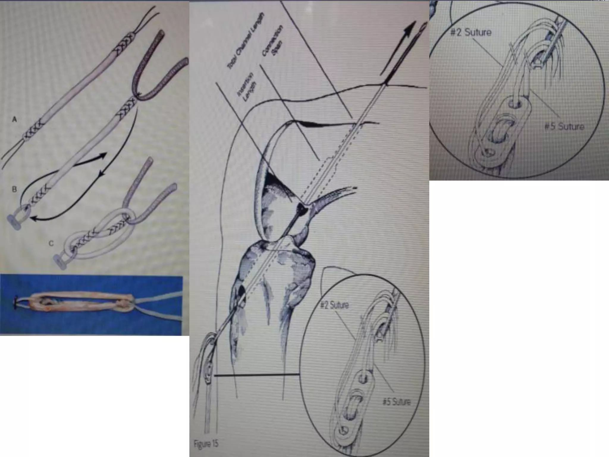 ACL reconstruction quadrapled hamstring graft | PPTX