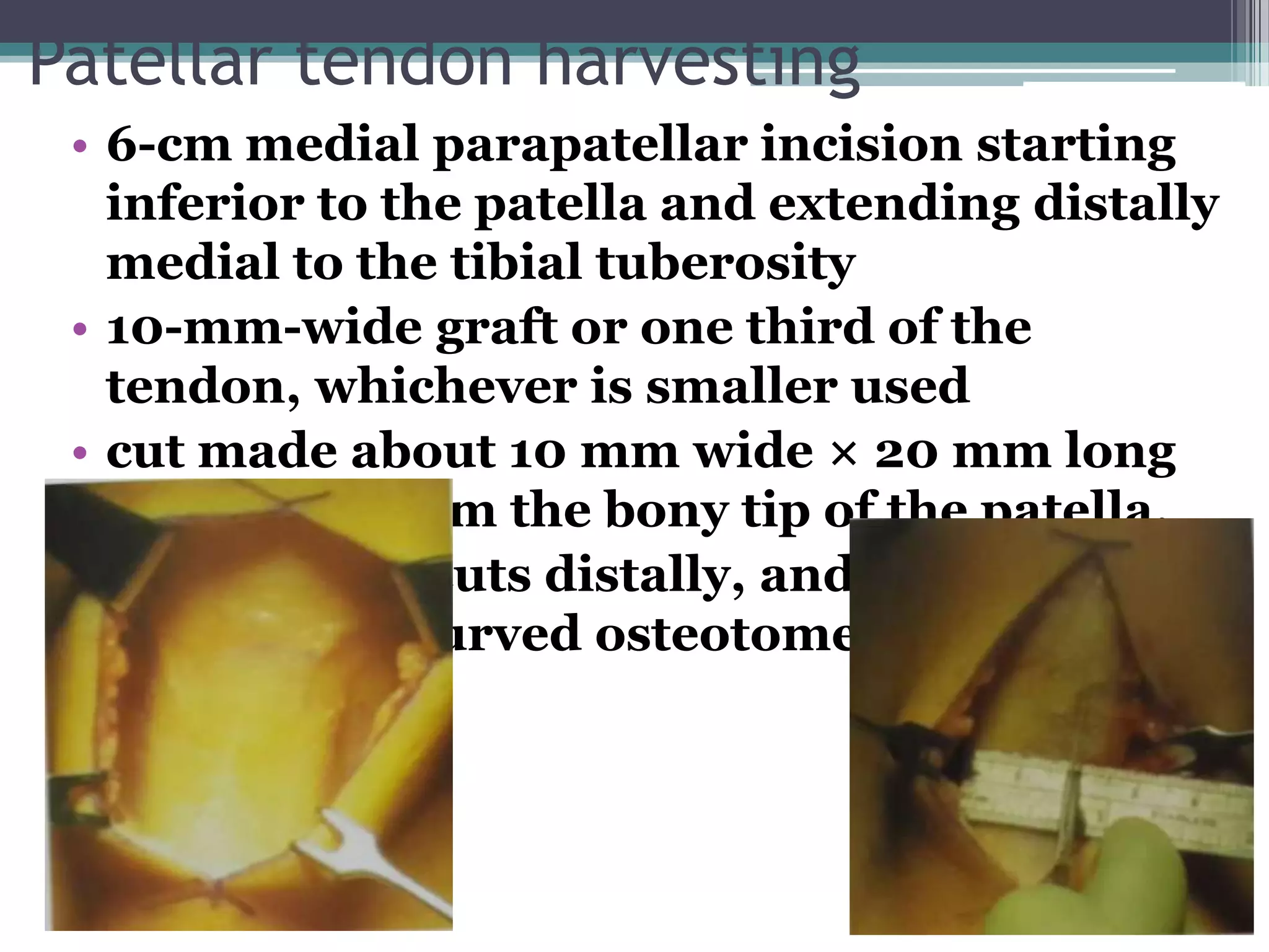 ACL reconstruction quadrapled hamstring graft | PPTX