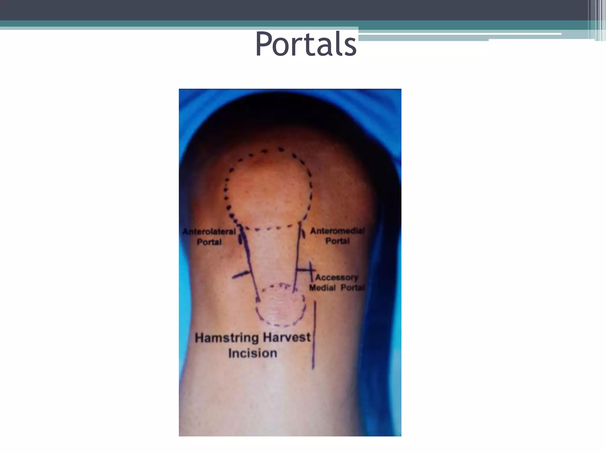 ACL reconstruction quadrapled hamstring graft | PPTX