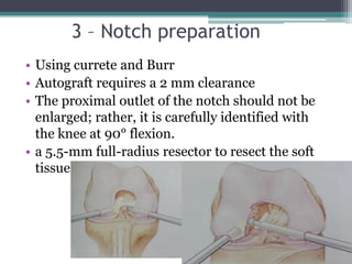 ACL reconstruction quadrapled hamstring graft | PPTX
