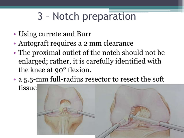 Acl Reconstruction Quadrapled Hamstring Graft Ppt