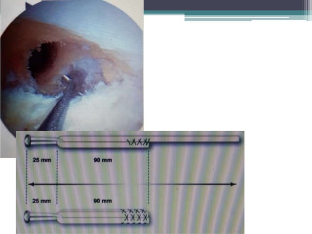 ACL reconstruction quadrapled hamstring graft | PPTX