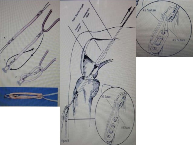 ACL reconstruction quadrapled hamstring graft | PPTX
