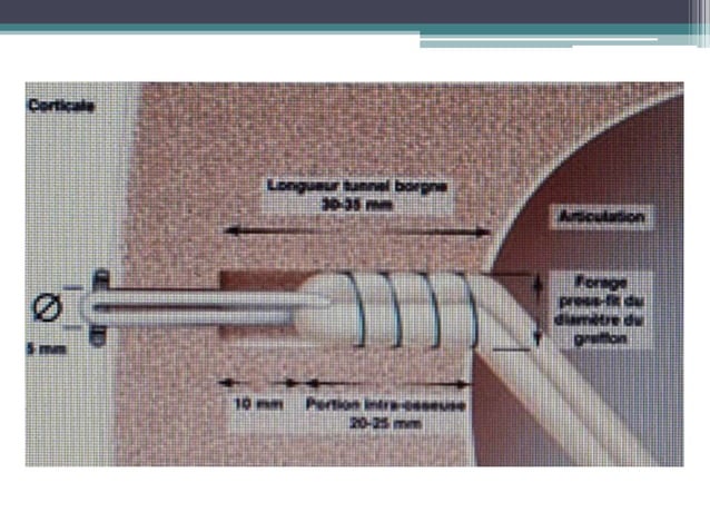 ACL reconstruction quadrapled hamstring graft | PPTX