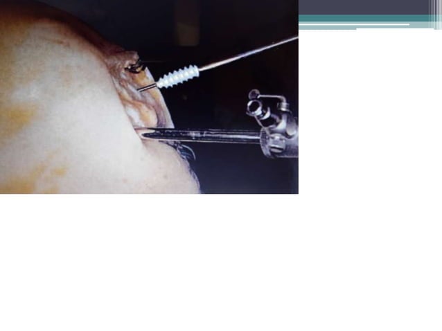 ACL reconstruction quadrapled hamstring graft | PPTX