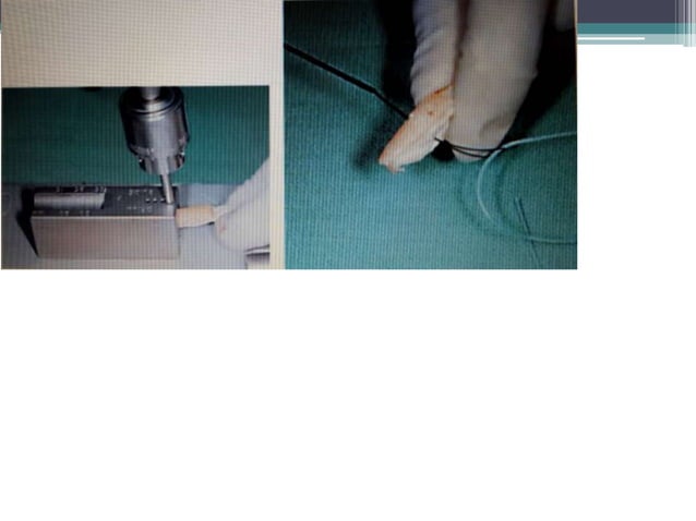 ACL reconstruction quadrapled hamstring graft | PPTX