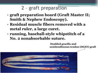 ACL reconstruction quadrapled hamstring graft | PPTX