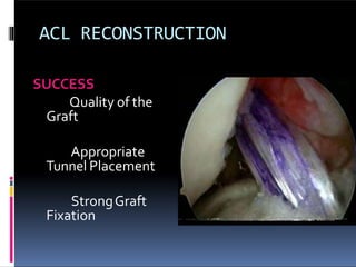 ACL Recon.pptx