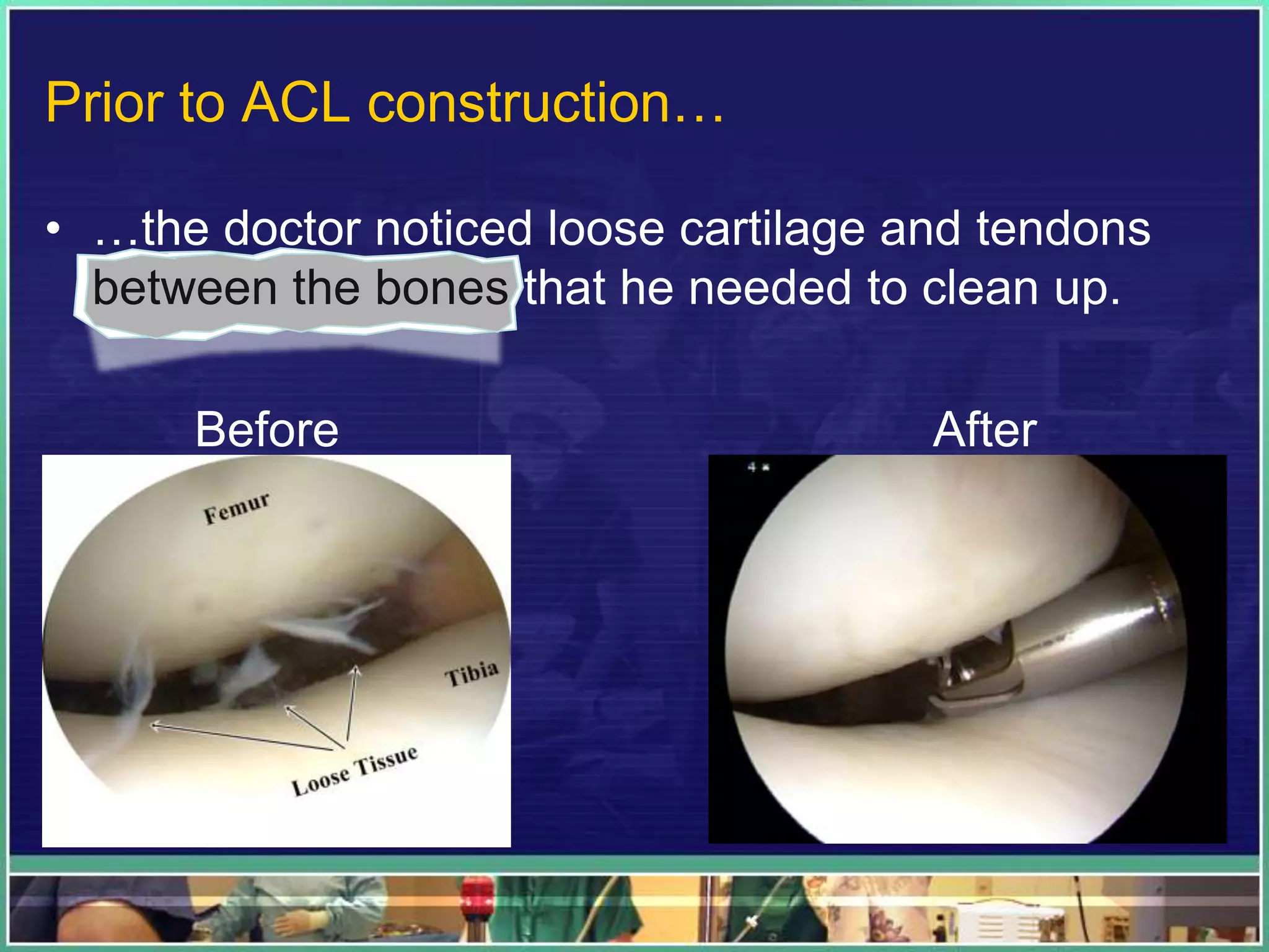 My ACL Reconstruction | PPTX