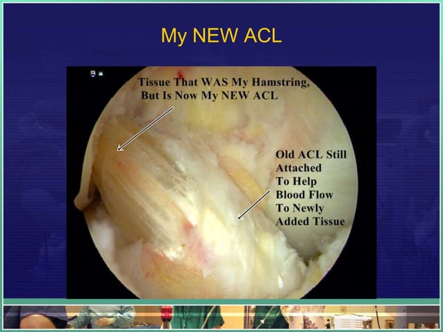 My ACL Reconstruction | PPTX