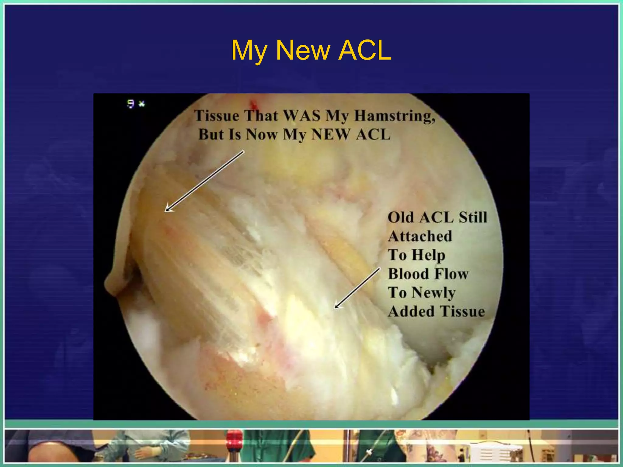ACL Reconstruction | PPTX