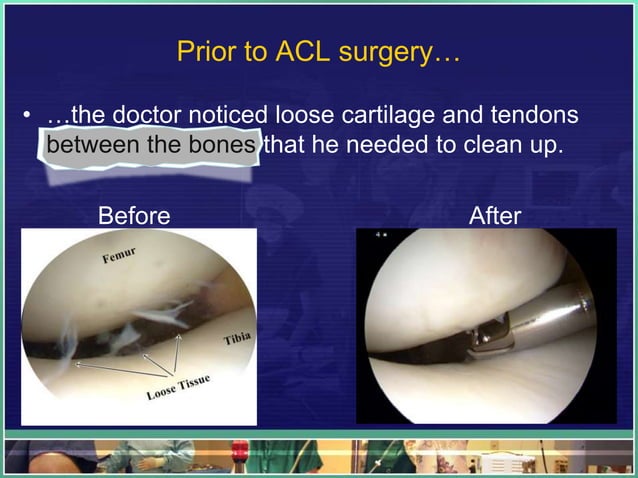 ACL Reconstruction | PPTX