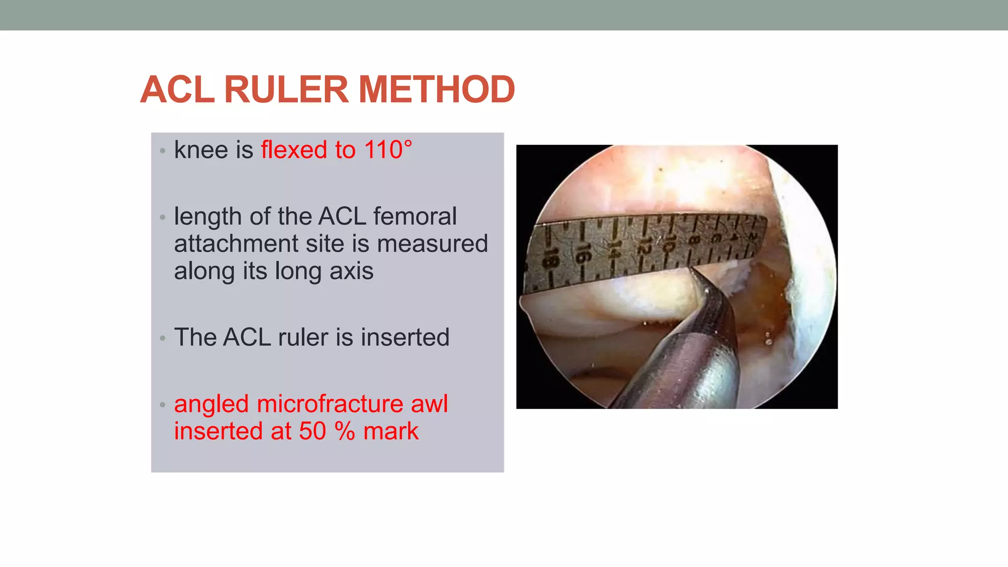 Acl reconstruction | PPTX