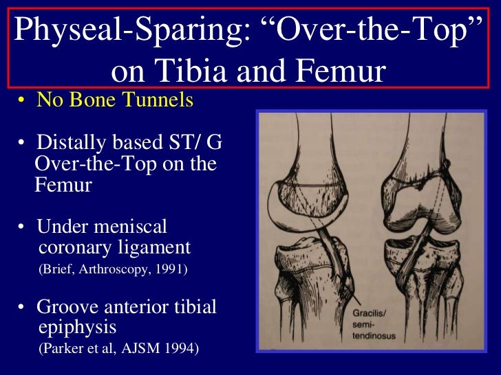 ACL Reconstruction in the Adolescent Athlete