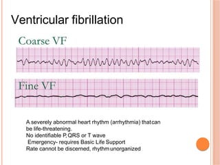 Fine Ventricular Fibrillation Vs Coarse Ventricular Fibrillation