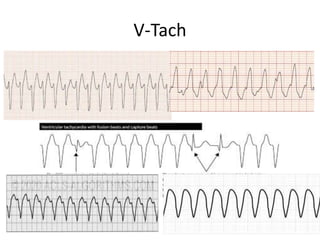 ACLS.pptx