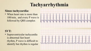 ACLS design to response effectively in cardiac emergency | PPTX