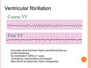 Fine Ventricular Fibrillation Vs Coarse Ventricular Fibrillation