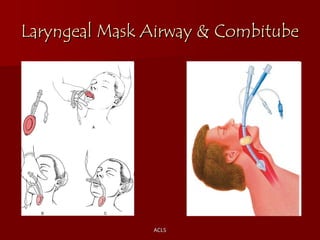 acls-airway-baru1. untuk keperawatan mahasiswa | PPT