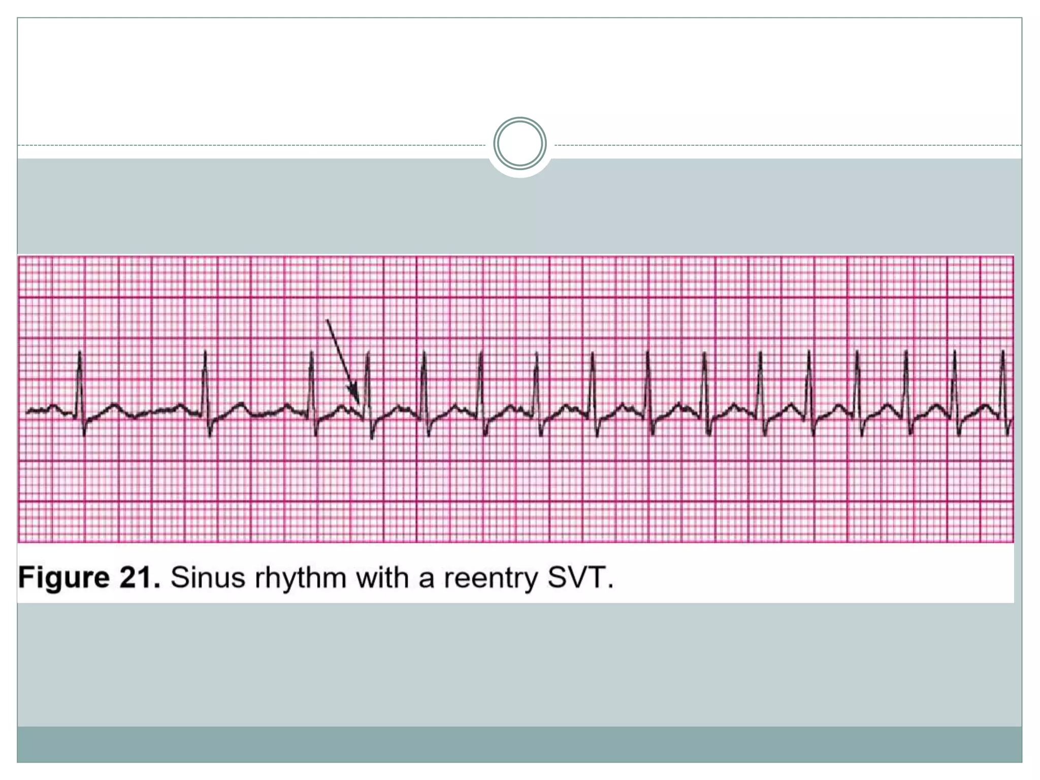 Adult cardiac life support(ACLS) | PPTX