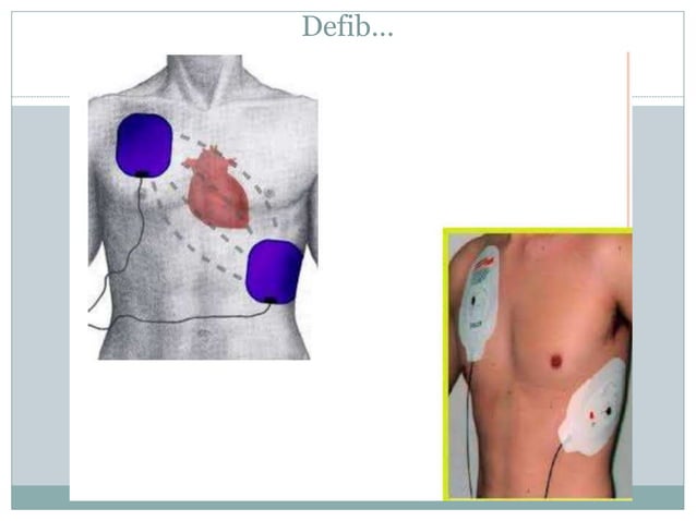 Adult cardiac life support(ACLS) | PPTX | First Aid | Injuries