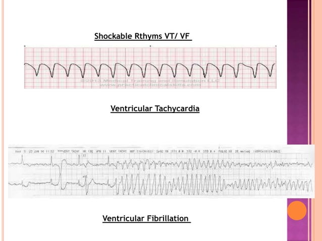Acls update-160228152124 | PPTX