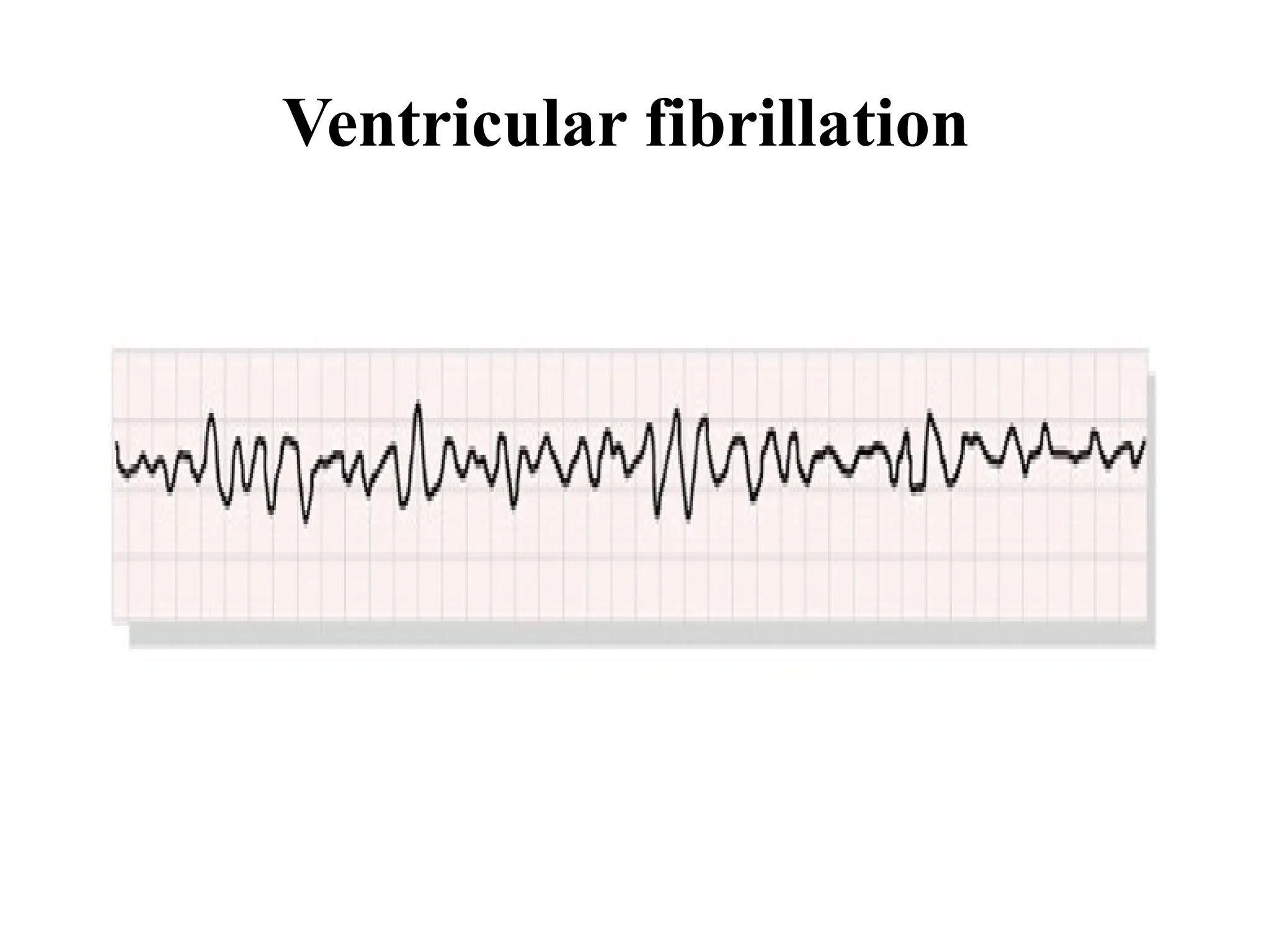 Advanced Cardiac Life Support Acls Shockable Non Shockable Rhythm