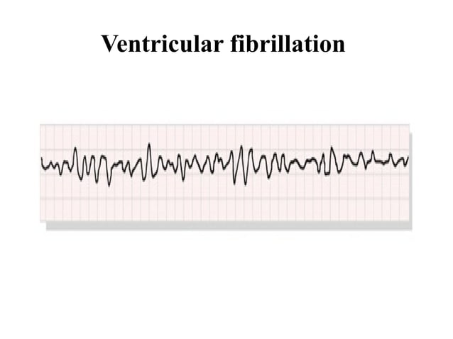 advanced Cardiac life support (ACLS), Shockable -non-shockable rhythm ...