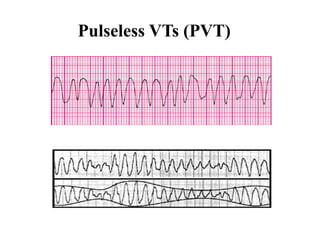 advanced Cardiac life support (ACLS), Shockable -non-shockable rhythm ...