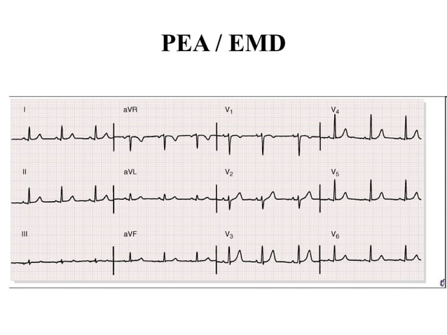 advanced Cardiac life support (ACLS), Shockable -non-shockable rhythm ...