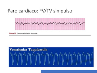 Taquicardia Ventricular Sin Pulso