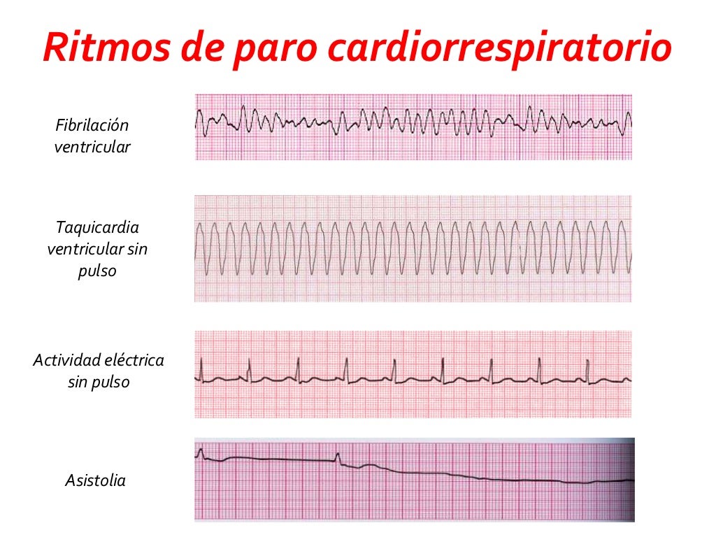 Tipos De Ritmos Cardíacos - BRAINCP