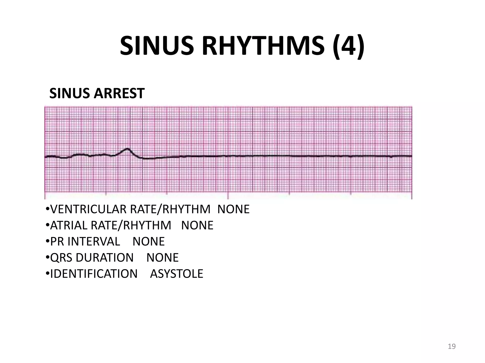 ACLS CE -Part I of III -ECG STRIP INTERPRETATION w Case Scenarios Supplemental | PDF