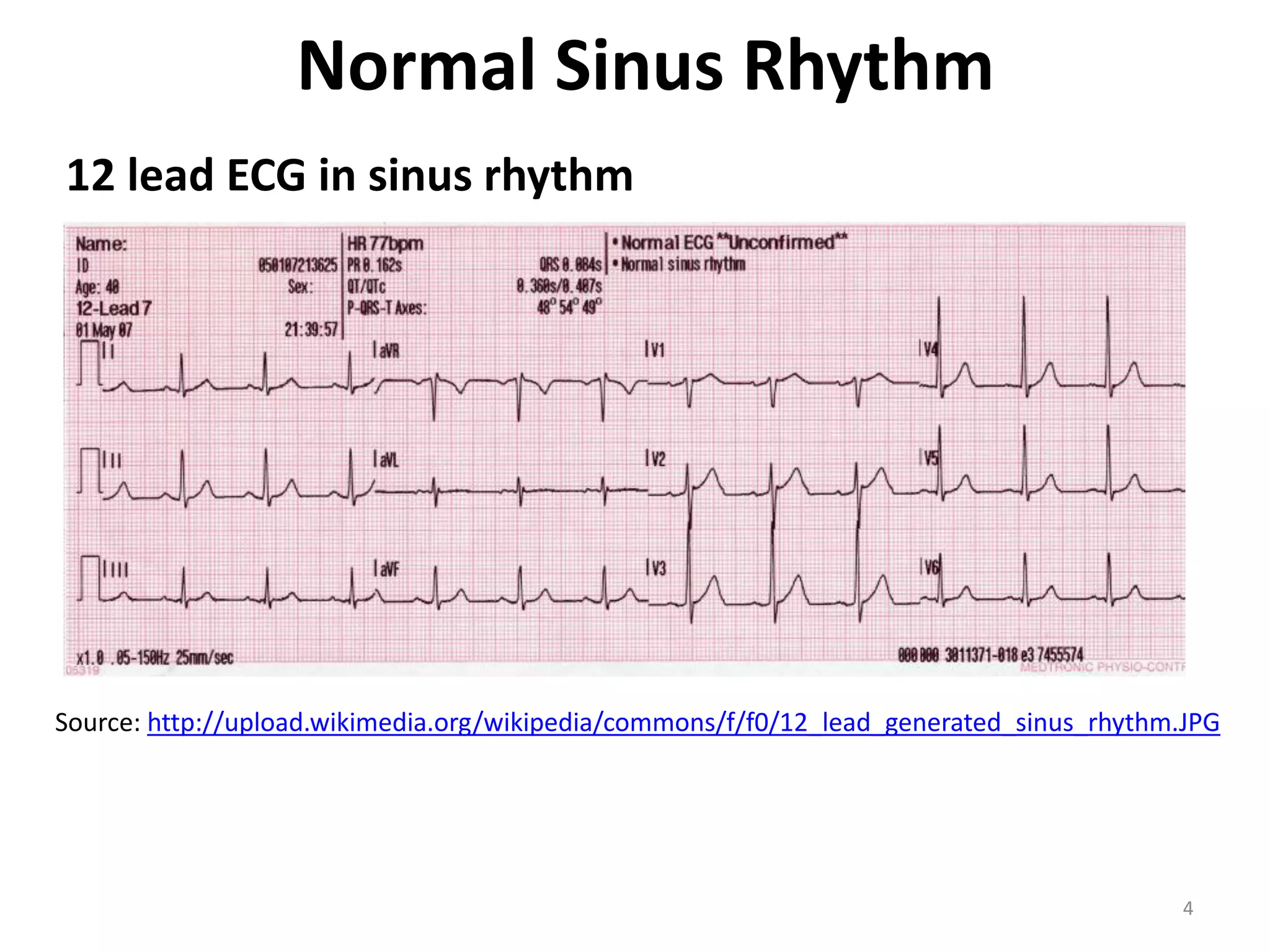 ACLS CE -Part I of III -ECG STRIP INTERPRETATION w Case Scenarios ...