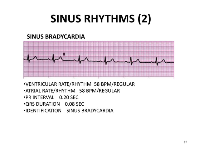 ACLS CE -Part I of III -ECG STRIP INTERPRETATION w Case Scenarios Supplemental | PDF