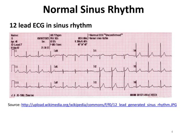 ACLS CE -Part I of III -ECG STRIP INTERPRETATION w Case Scenarios Supplemental | PDF