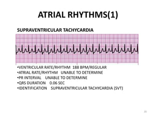 Supraventricular Tachycardia Rhythm Strip