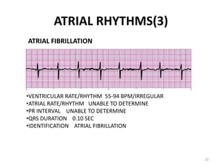 Hyperkalemia Ecg Strip