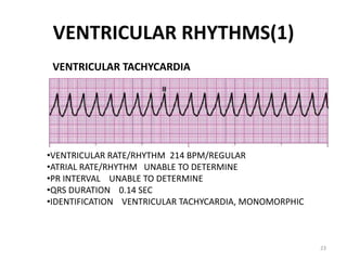 Pulseless Ventricular Tachycardia Ecg