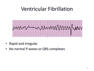 Ventricular Fibrillation Rhythm Strip