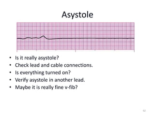 Asystole Rhythm Strip