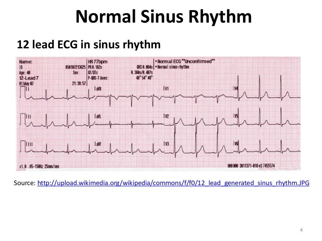 ACLS CE -Part I of III -ECG STRIP INTERPRETATION w Case Scenarios Sup…