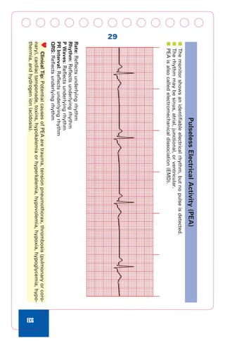 Pulseless Electrical Activity Acls