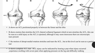 changes in gait pattern after injury and rehabilitation of the Anterior ...
