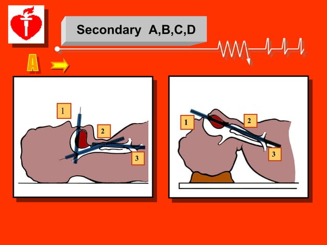Acls mega code pdf | PDF | First Aid | Injuries