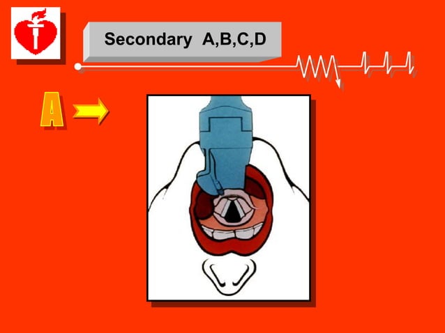 Acls mega code pdf | PDF | First Aid | Injuries